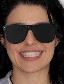 Before and After Smile Gallery | Fusion Orthodontics