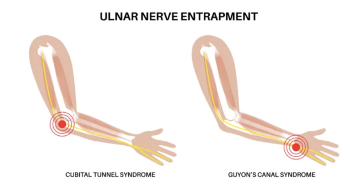 Ulnar Neuropathy | Vancouver Centre for Neuromuscular Disease