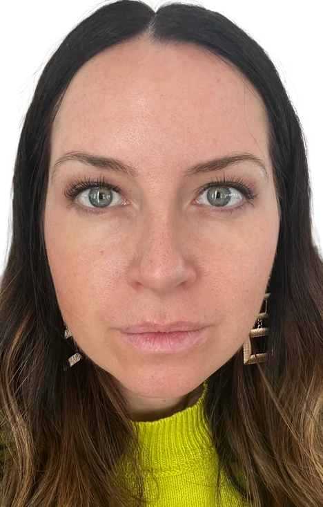 Dermal Fillers and Biostimulators | Skin Clique