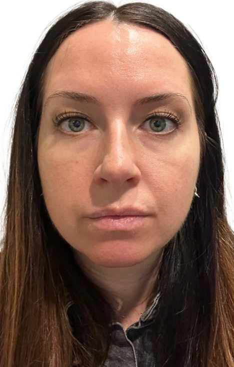 Dermal Fillers and Biostimulators | Skin Clique