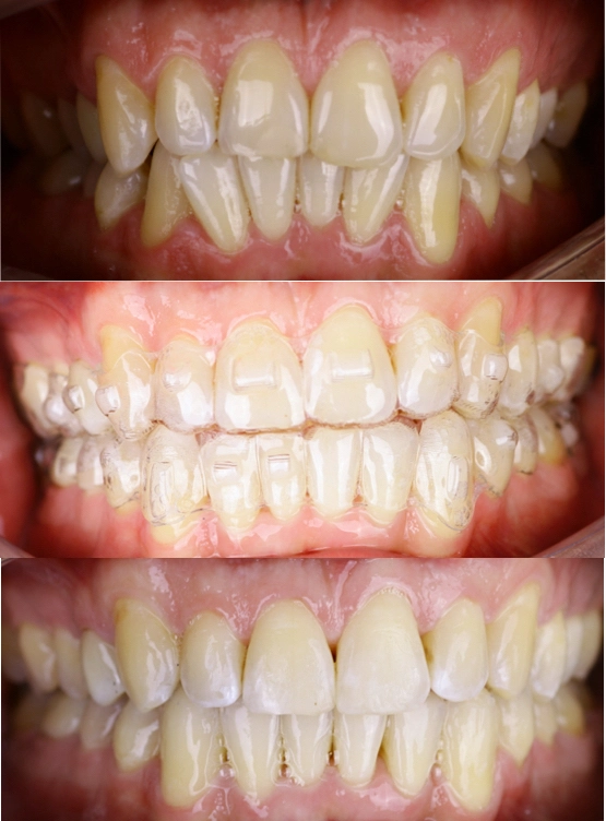 Before & Afters | Dr. Koval Orthodontics Boca Raton