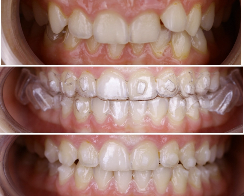 Before & Afters | Dr. Koval Orthodontics Boca Raton