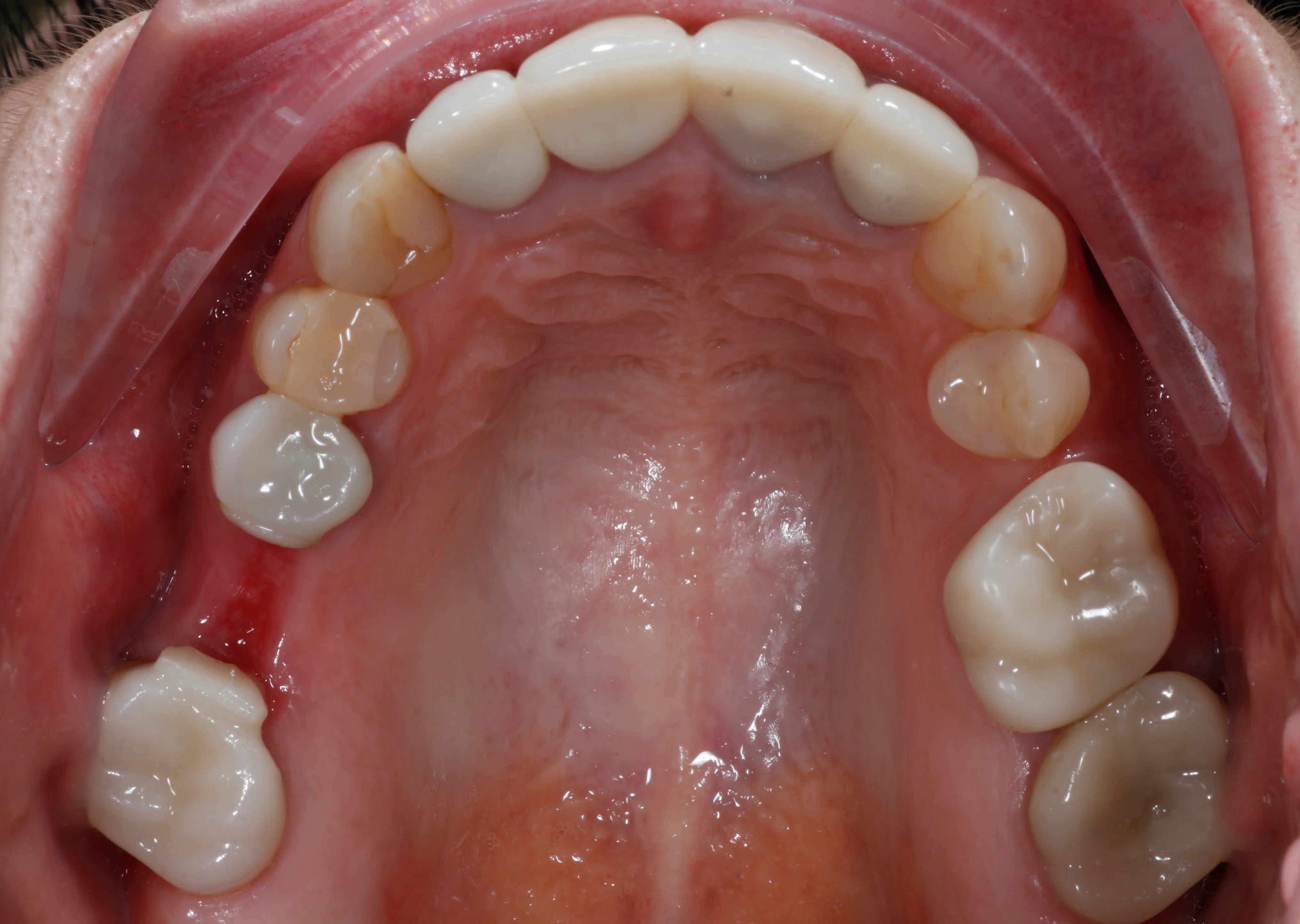 Before & Afters | Dr. Koval Orthodontics Boca Raton