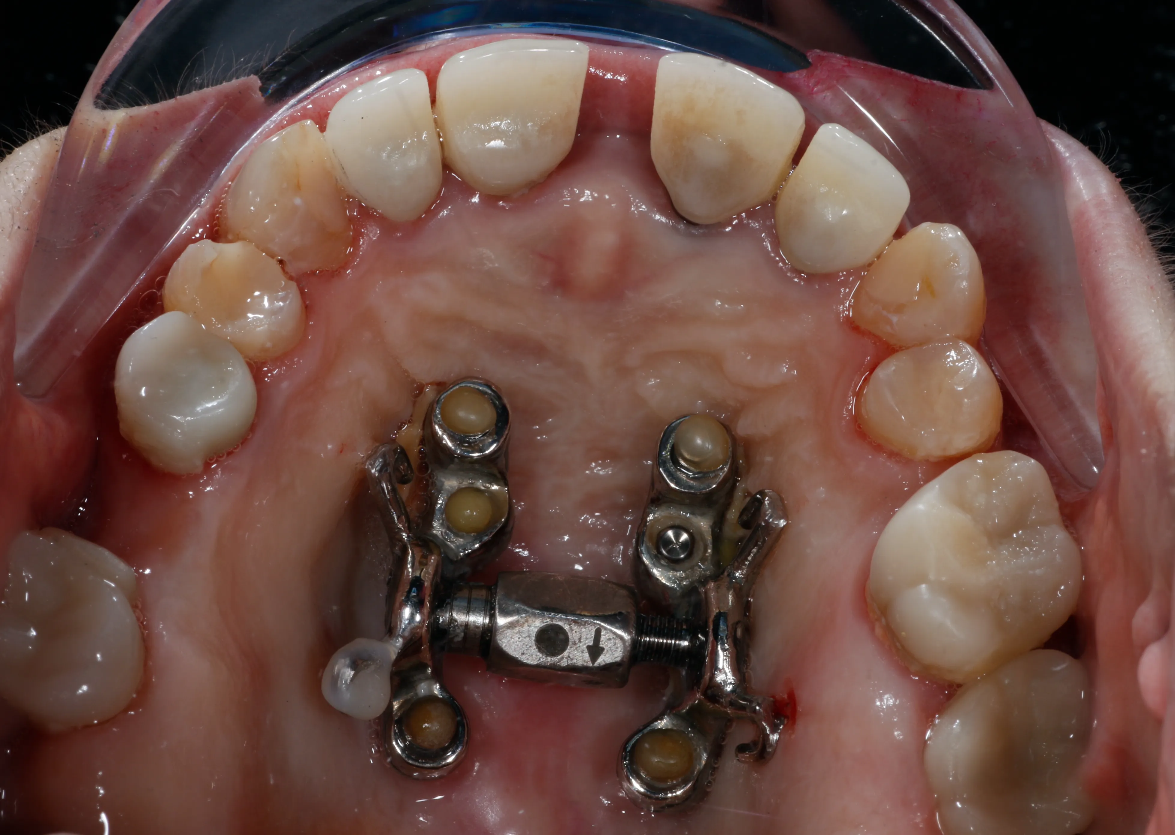 Before & Afters | Dr. Koval Orthodontics Boca Raton