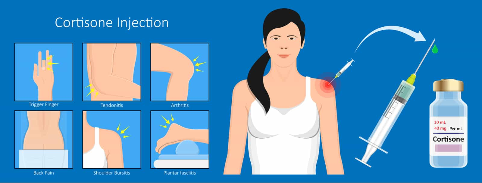 The pros and cons of cortisone shots for plantar fasciitis