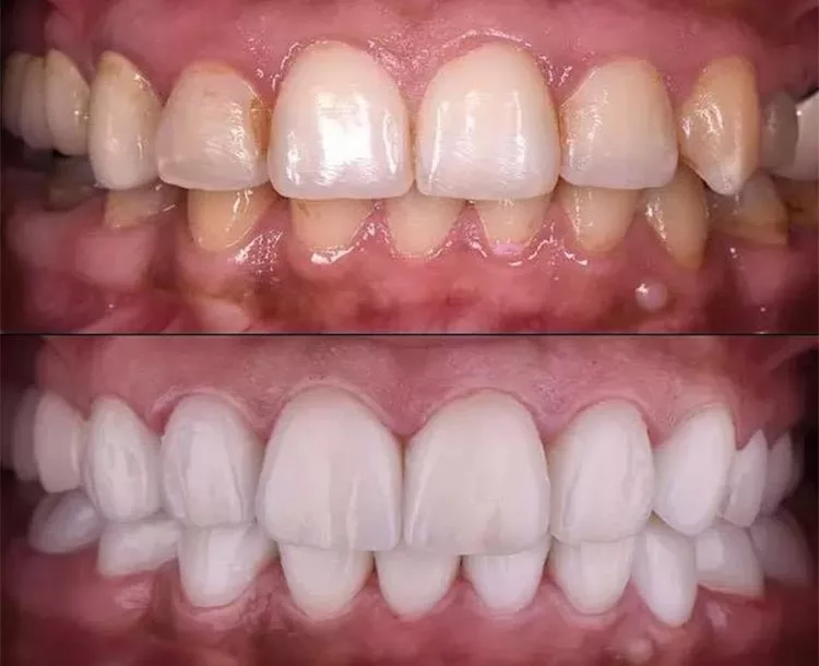 Denta Blast | Electric Teeth Cleaner | Removes Plaque Tartar