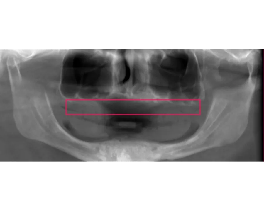 The Ultimate Guide To Full Mouth Dental Implants