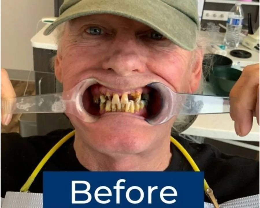 The Ultimate Guide To Full Mouth Dental Implants