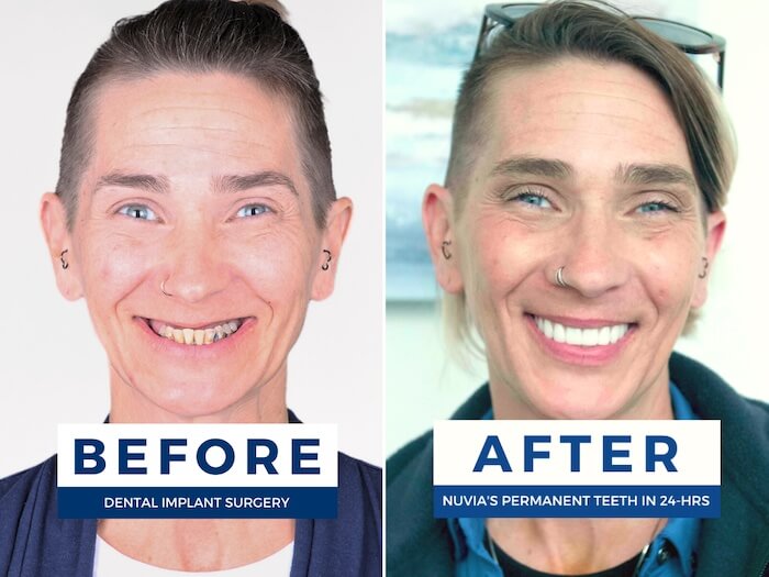 Nuvia's Permanent 24hr Smile vs "Teeth-In-A-Day"