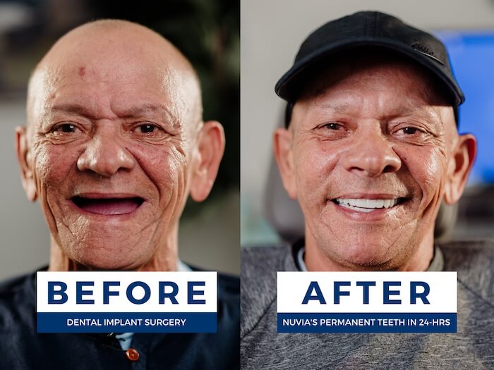 Nuvia's Permanent 24hr Smile vs "Teeth-In-A-Day"