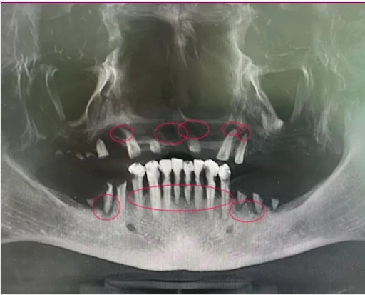 Dental Implant Cost And Information Guide