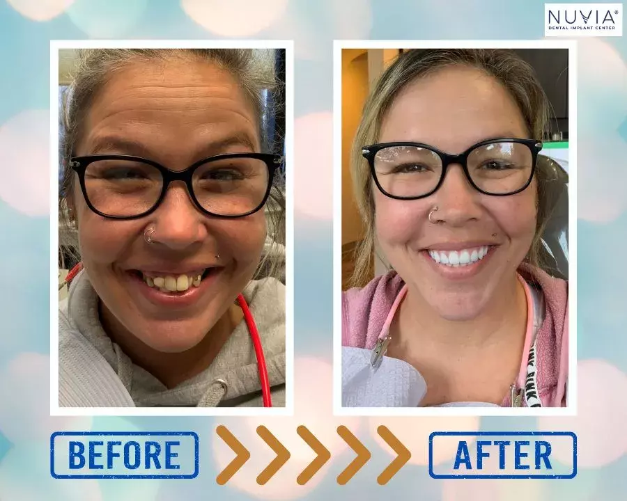 Dental Implant Cost And Information Guide