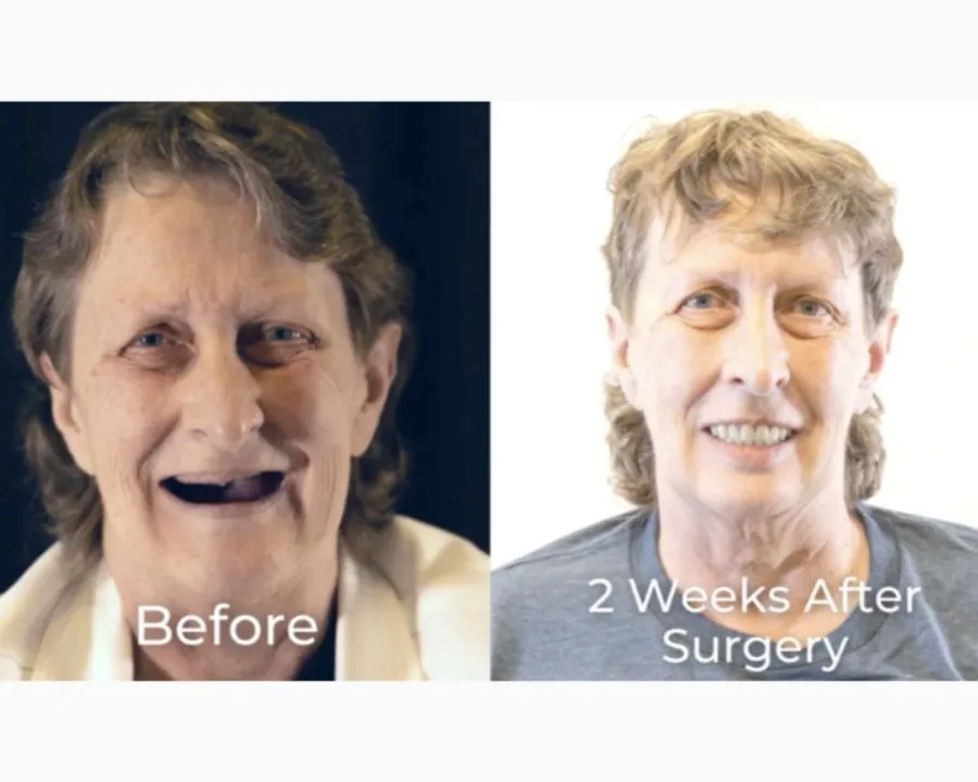 Dental Implant Cost And Information Guide