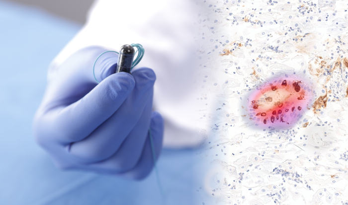 Artificial Intelligence for early cancer detection | Cyted