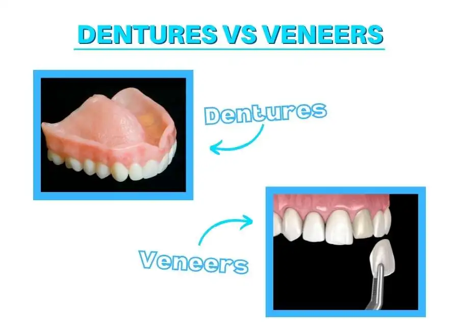 Dentures Vs Veneers – The Differences – What’s The Better Choice?