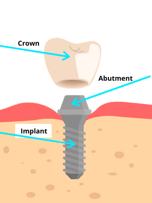How Long Dental Implants Last