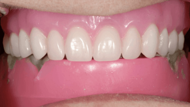 Nuvia's Permanent Teeth in 24 Hours VS Teeth-In-A-Day.