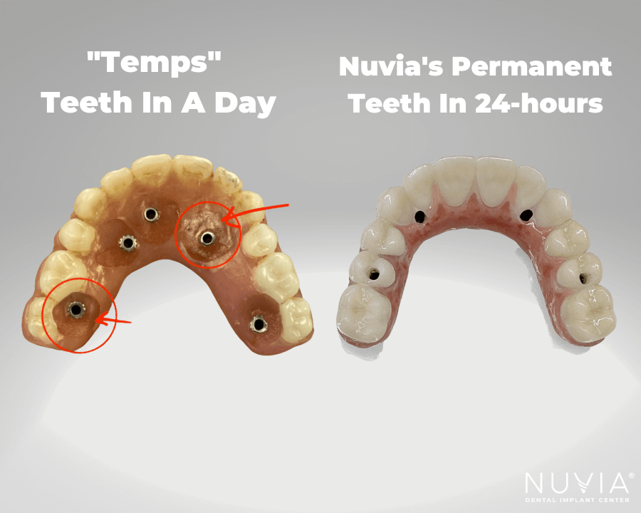 Traditional Dental Implants vs. Nuvia's Permanent Teeth in 24 Hours