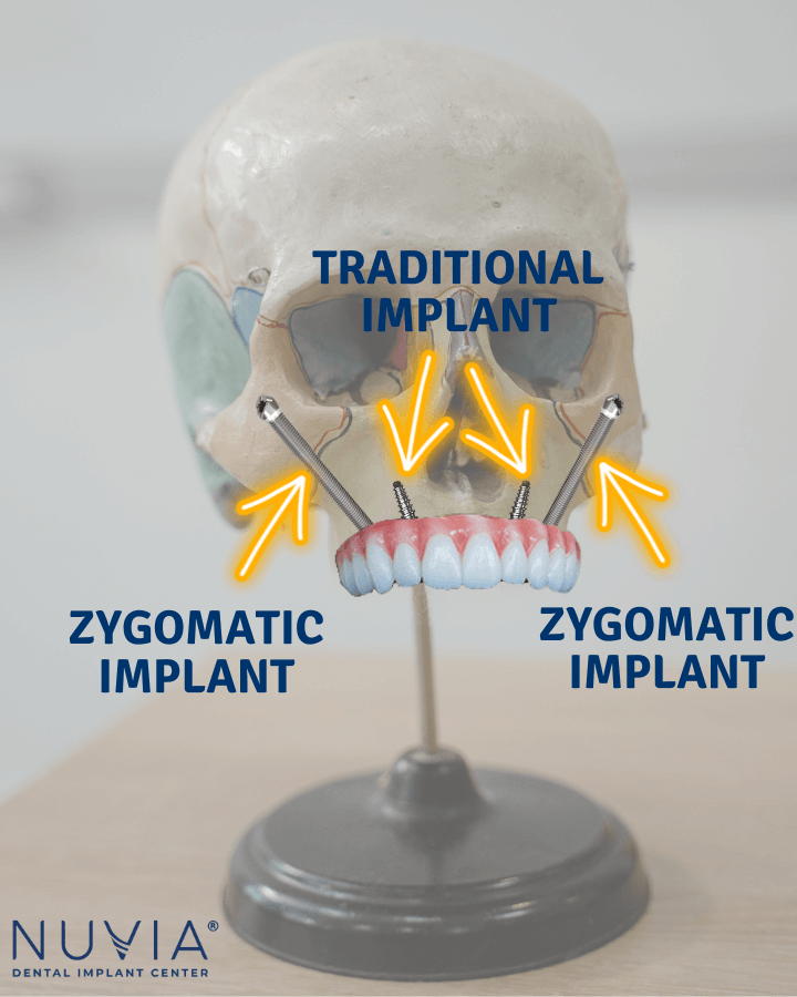 15 Things about Zygomatic Dental Implants You Should Know.