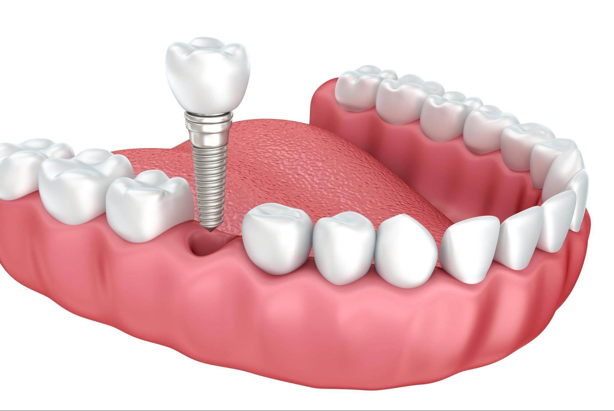 How Long Dental Implants Last