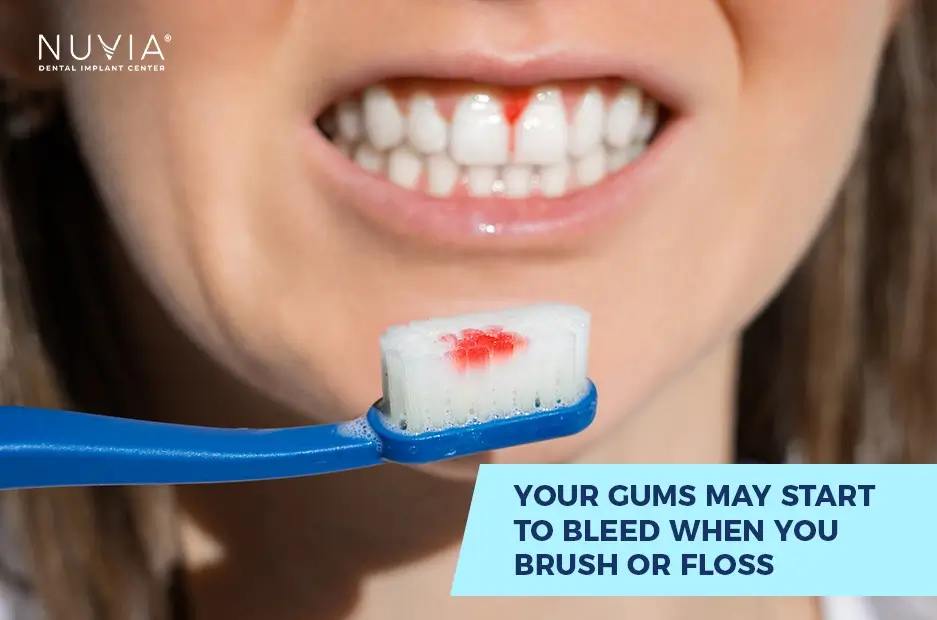 Early Warning signs of poor gum health.