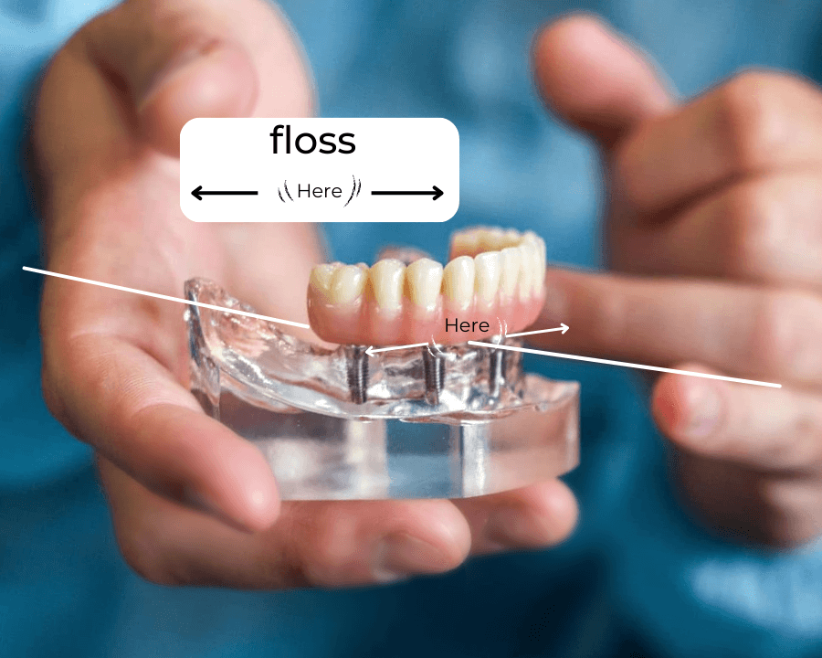 Flossing Dental Implants