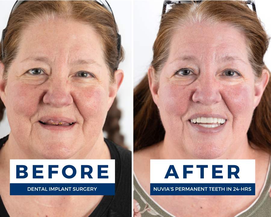Looking to Replace Missing Teeth? Permanent Teeth in 24 Hours Solution