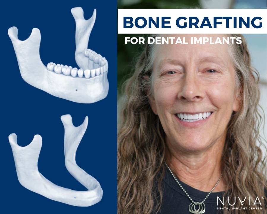 Is Bone Grafting for Dental Implants a Necessary Procedure?