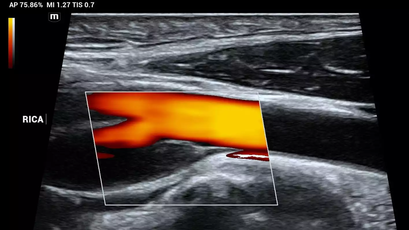 Why You Should Have the CIMT Test | Nexus HealthSpan Wellness Center ...