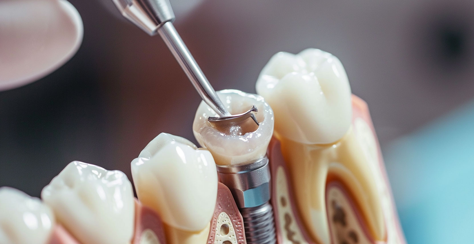 Endodontics Expertise | Root Canal Treatment in Santa Ana