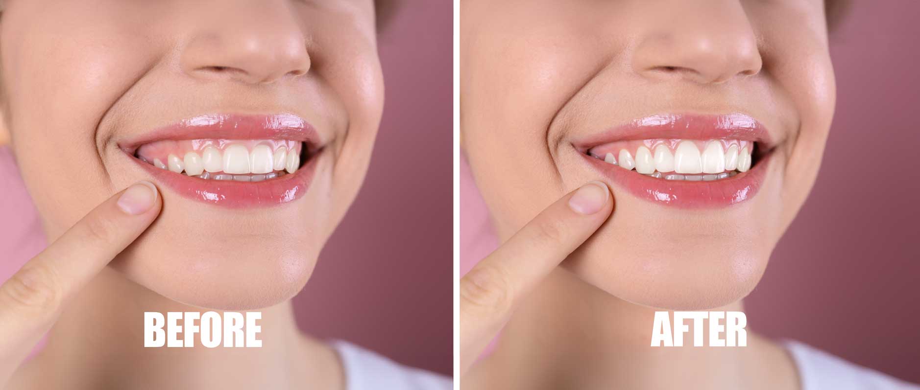 Cosmetic Gum Contouring in Santa Ana | Perfect Your Smile