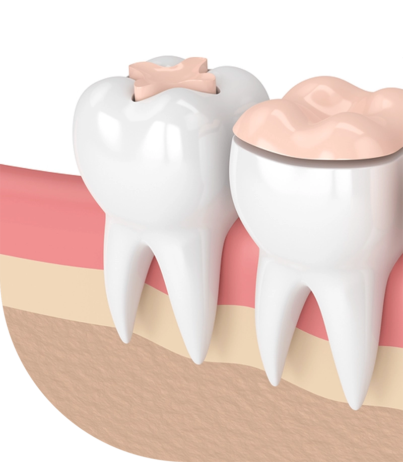Dental Inlays & Onlays in Santa Monica at Wilshire Dental