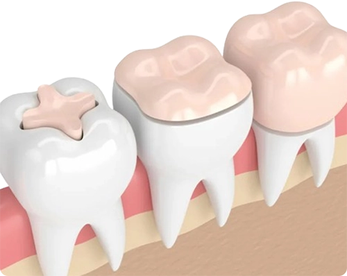 Dental Inlays & Onlays in Santa Monica at Wilshire Dental