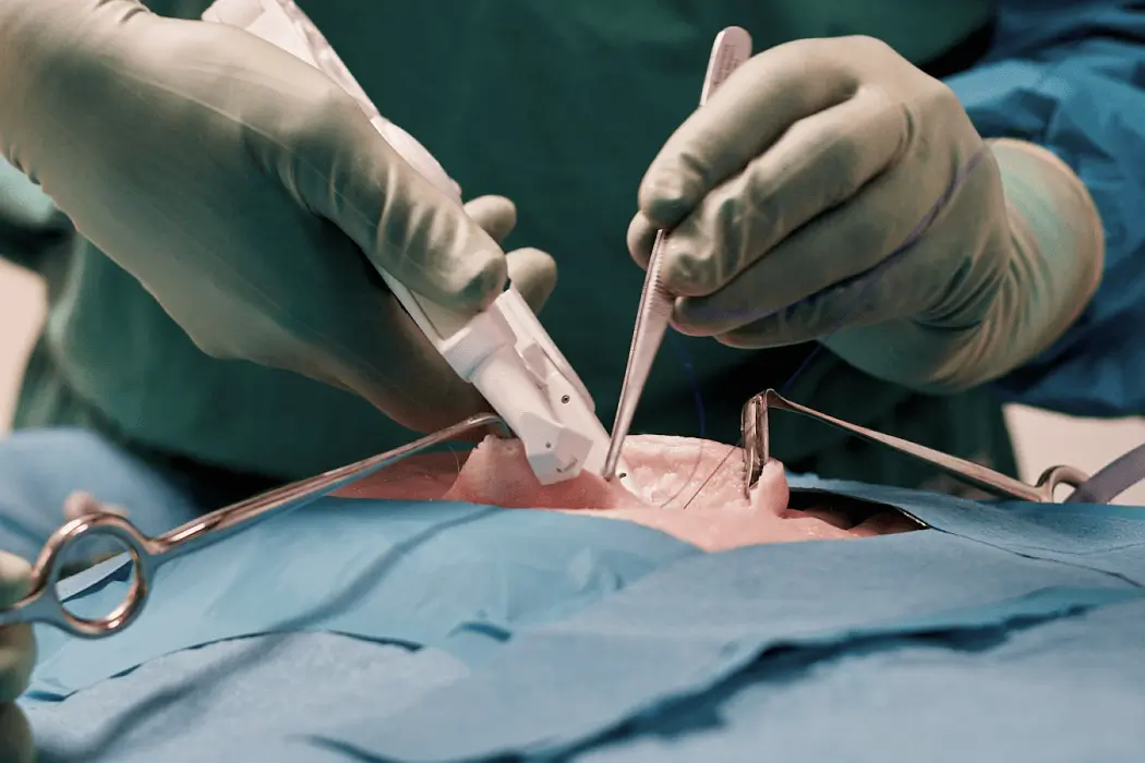 A new suturing choice for abdominal wall closure.