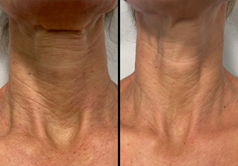 Profhilo London - Profhilo Before And After - Anti Wrinkle Clinic