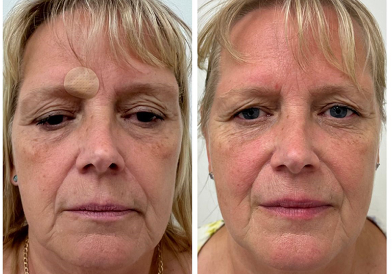 Profhilo London - Profhilo Before And After - Anti Wrinkle Clinic