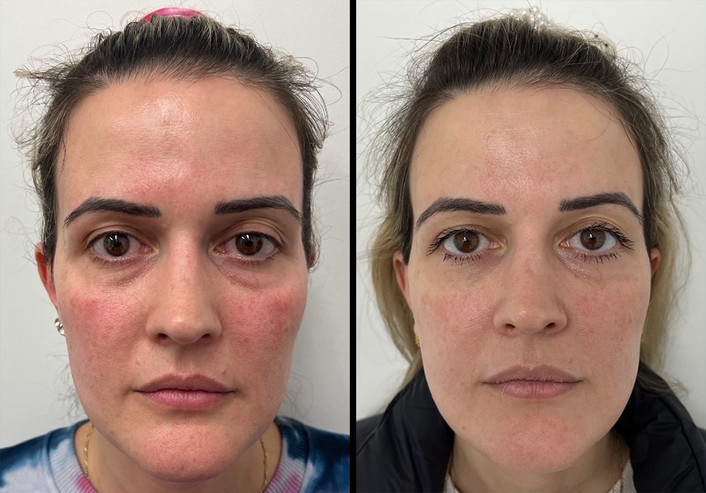 Profhilo London - Profhilo Before And After - Anti Wrinkle Clinic