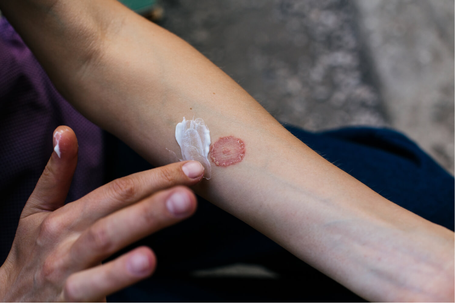 Ringworm Treatment in Charlottesville, VA