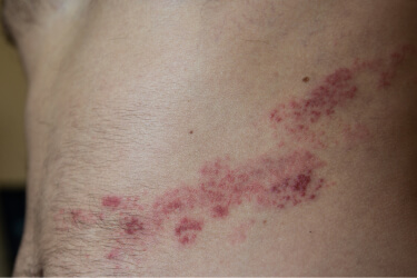 Dermatology Services in Charlottesville, VA