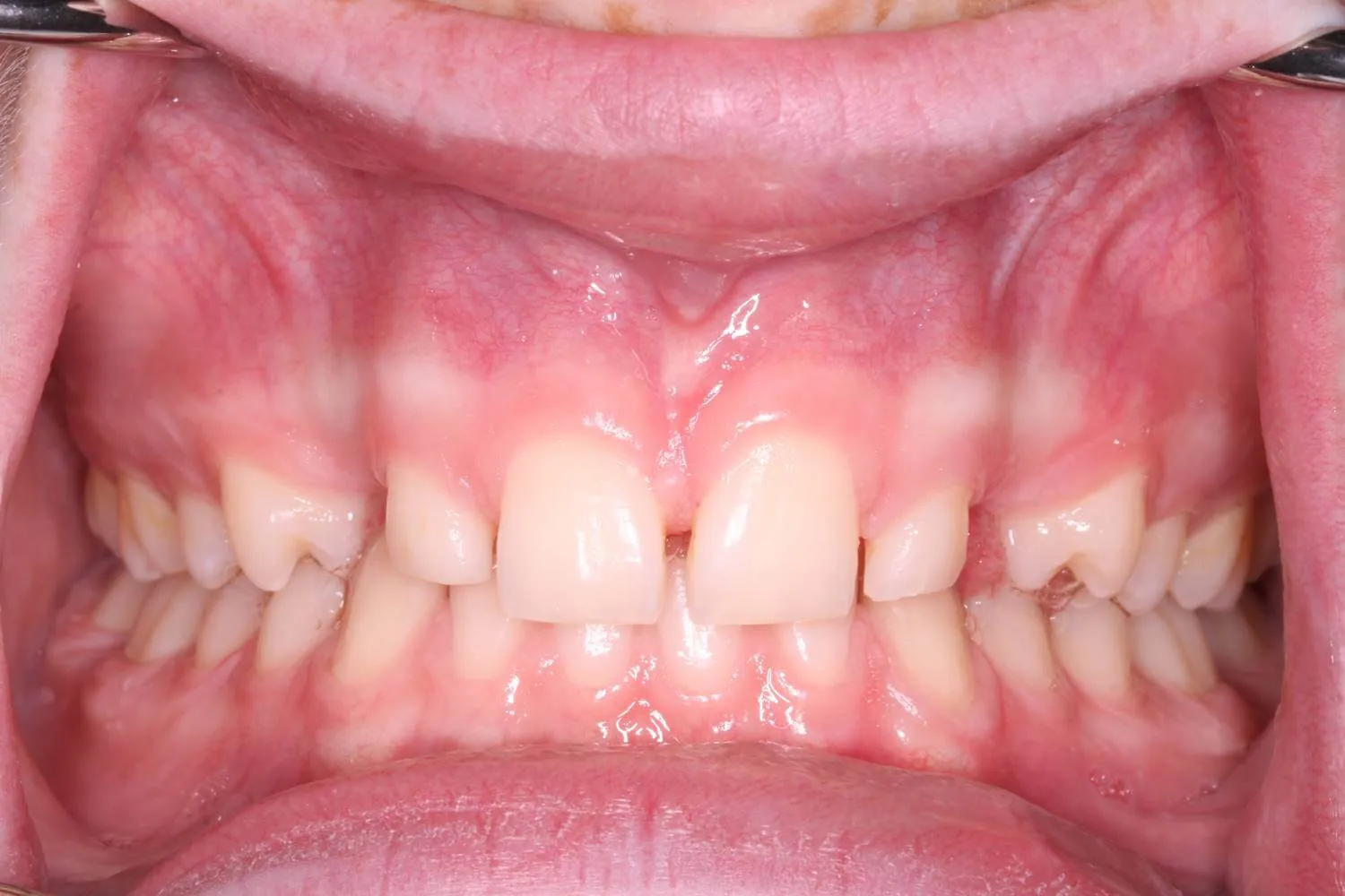 Spacing | Terenure Orthodontic | Dr. Joseph O'Connor