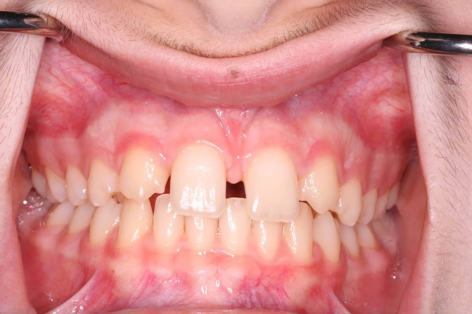 Spacing | Terenure Orthodontic | Dr. Joseph O'Connor