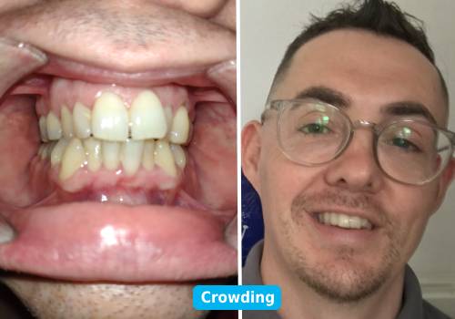 StraightMyTeeth: Your Guide to Teeth Straightening