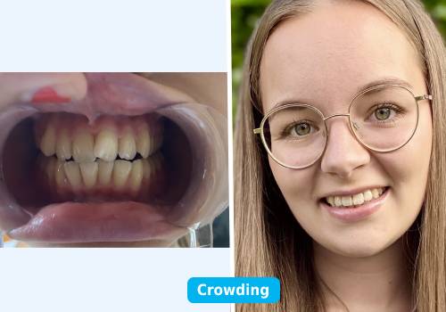 StraightMyTeeth: Your Guide to Teeth Straightening