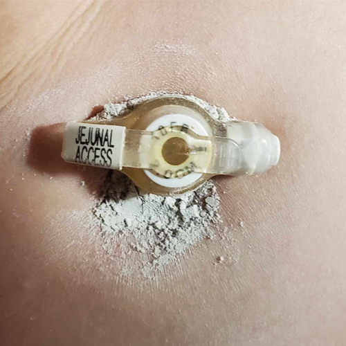 Stoma Ease - Relief for enteral stomas