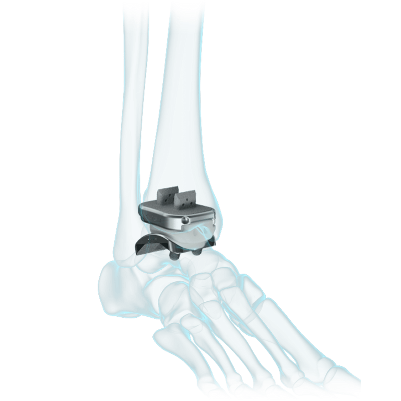 The Future of Personalized Musculoskeletal Reconstruction | restor3d
