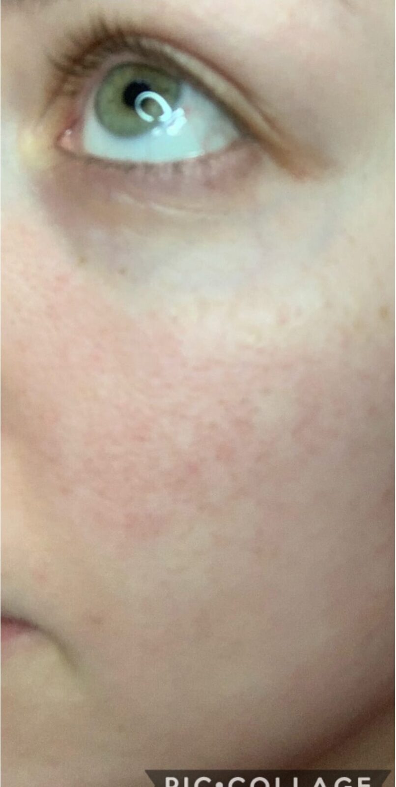 Laser Pigment Fix - Mentor | Northcoast Laser Medspa