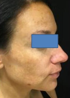 LASEMD® Rejuvenation - Mentor