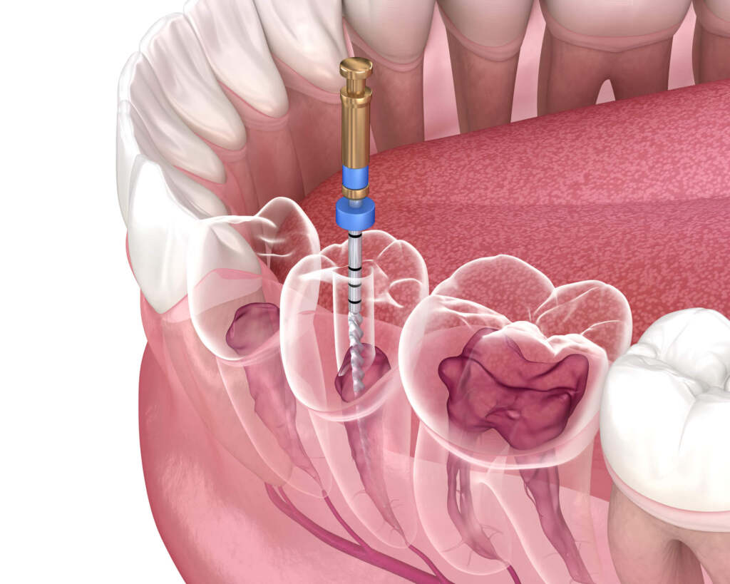 Perfect Smile Braces