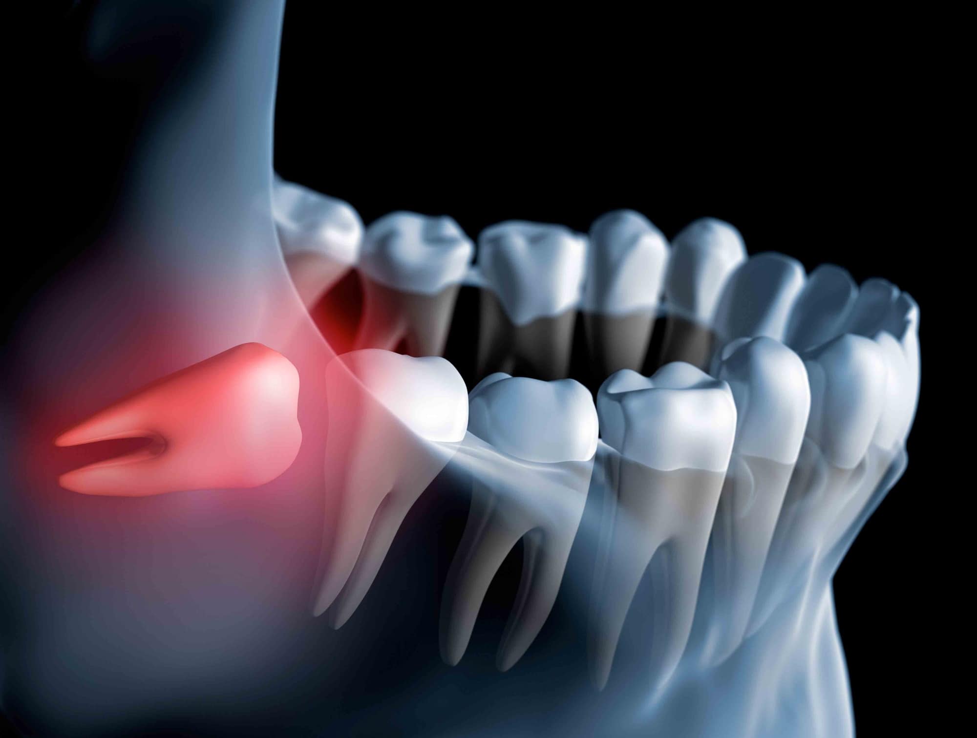 Saying Goodbye to Wisdom Teeth Discomfort | Irvine Tooth Cafe ...