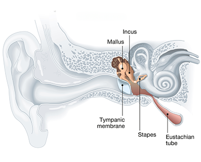 Chronic Otitis Media (Middle Ear Infections) | What To Know